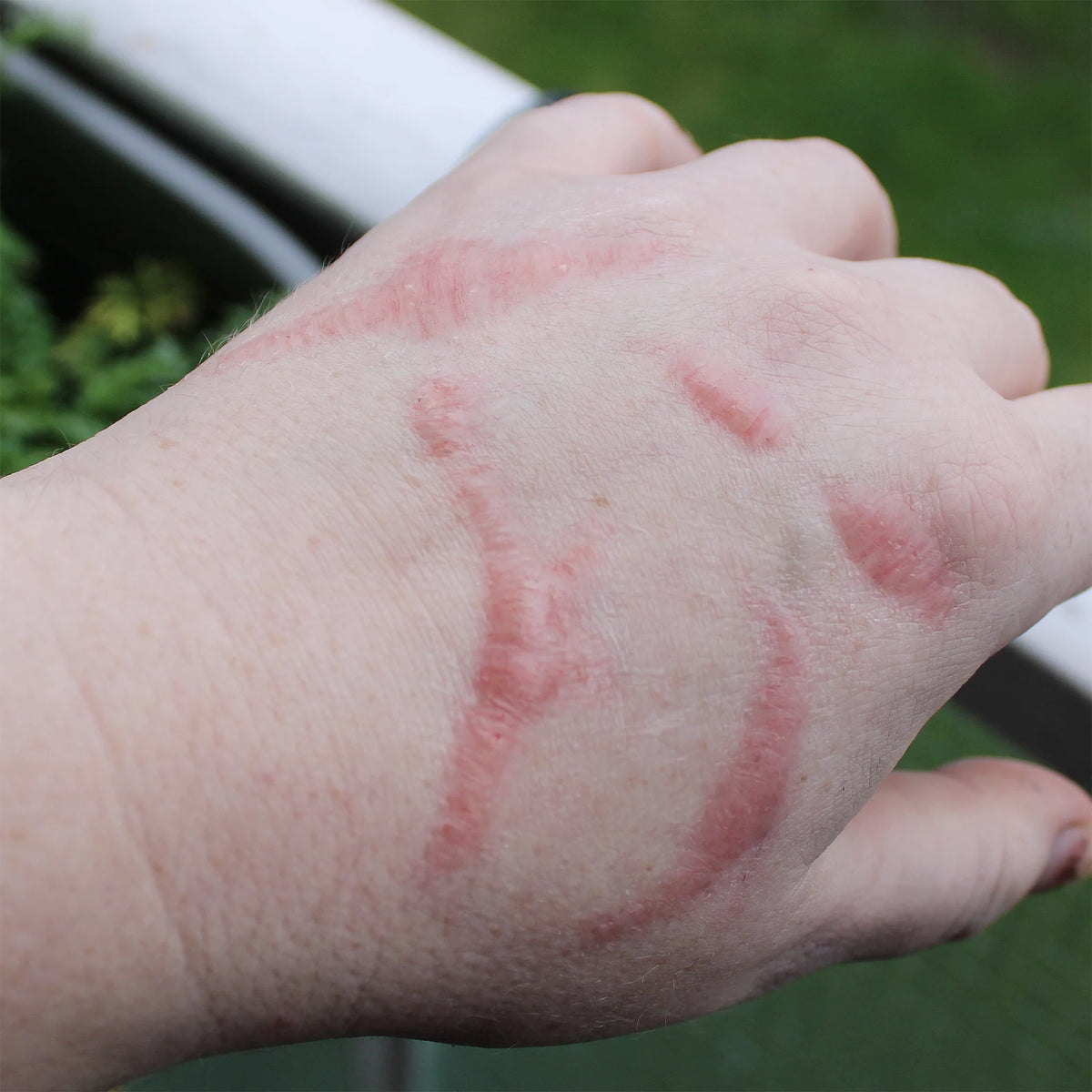 Jess FX - Silicone Bondo Mould - Healed Keloid Scar Small (5 Moulds ...