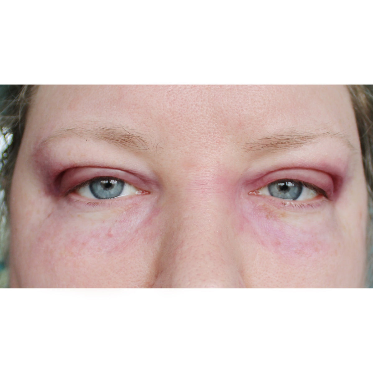 Jess FX - Silicone Bondo Mould - Swollen Eyelid – The Makeup Armoury